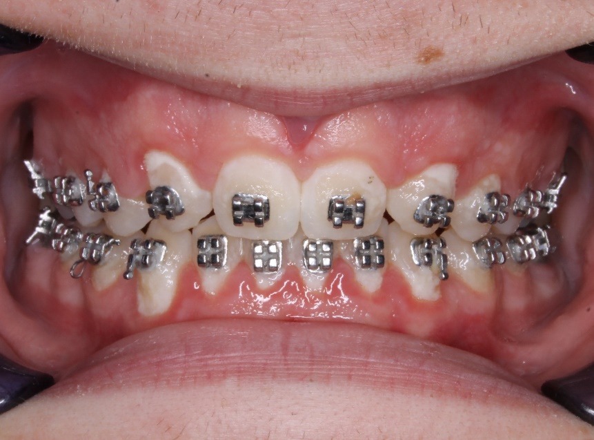 White Spot Lesions: Tales of an orthodontist and his broken heart